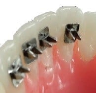 Tongue Tamers, Prestige Dental Products