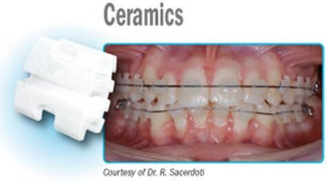 Ceramic Orthodontic Brackets, Prestige Dental Products