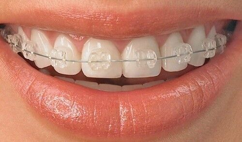 Pure Sapphire Bracket System, Prestige Dental Products